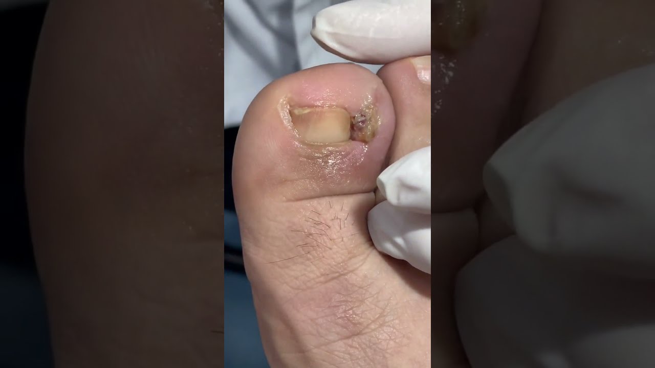 ASMR Toenail Cleaning Gel Removal - Throwback -ASMR 발톱 청소 젤 제거 - 후퇴 ...