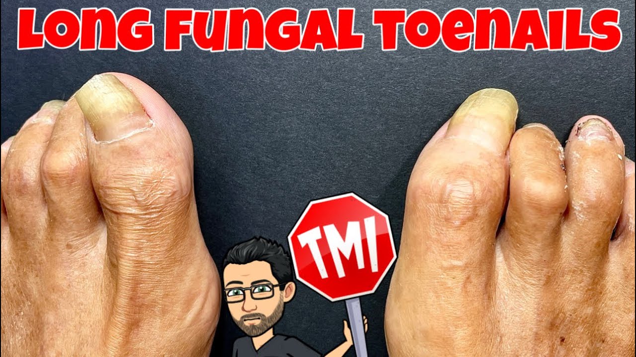 DEBRIDEMENT OF LONG FUNGAL TOENAILS - YouTube