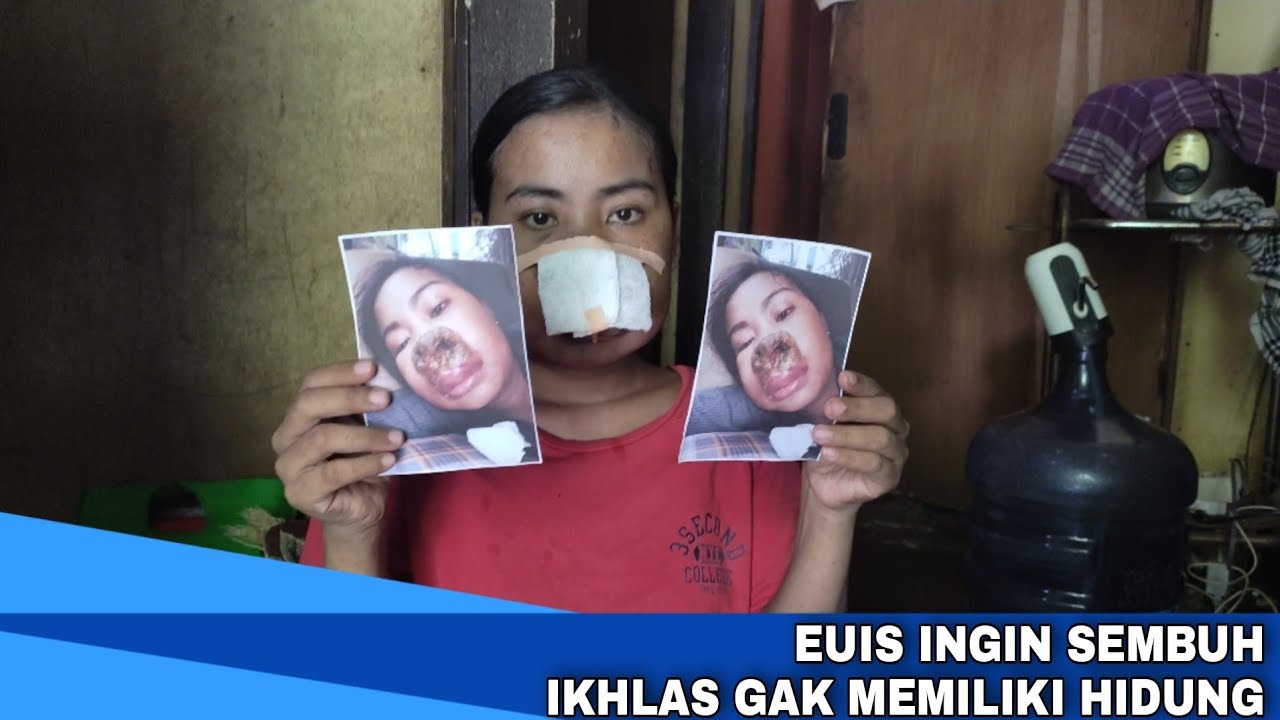 Euis Aisyah Penderita Tumor di Hidung Membutuhkan Uluran Tangan Untuk Kesembuhan - YouTube