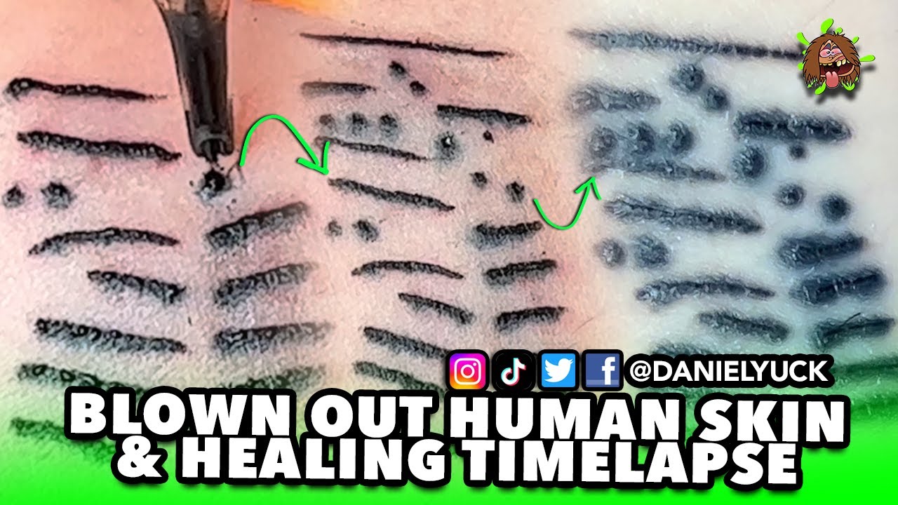 Blowing Out Human Skin & 1 Month Healing Timelapse 🩸 - YouTube