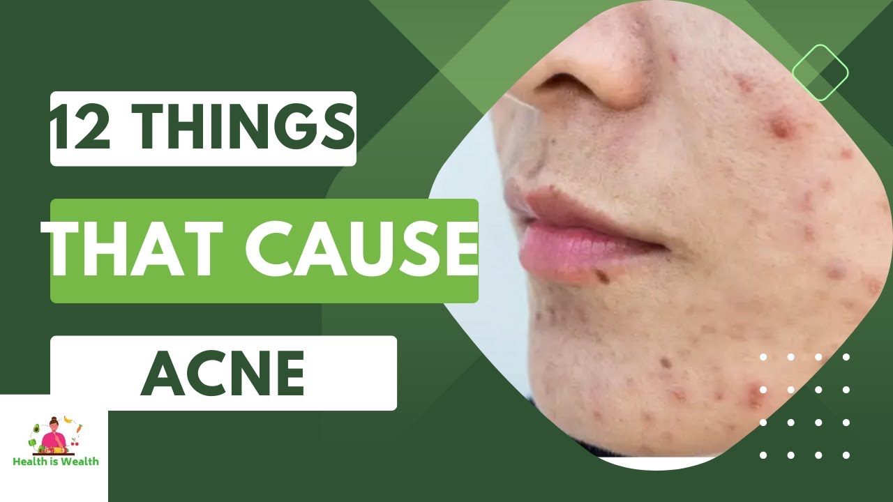 12 things that causes acne! - YouTube