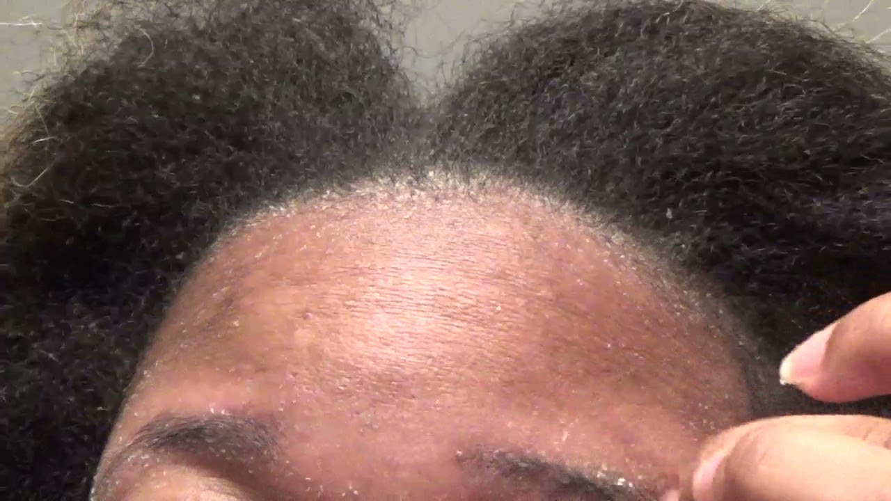 Dandruff Scratching | Scratching Dry Scalp & Eyebrow Flakes | Winter ...