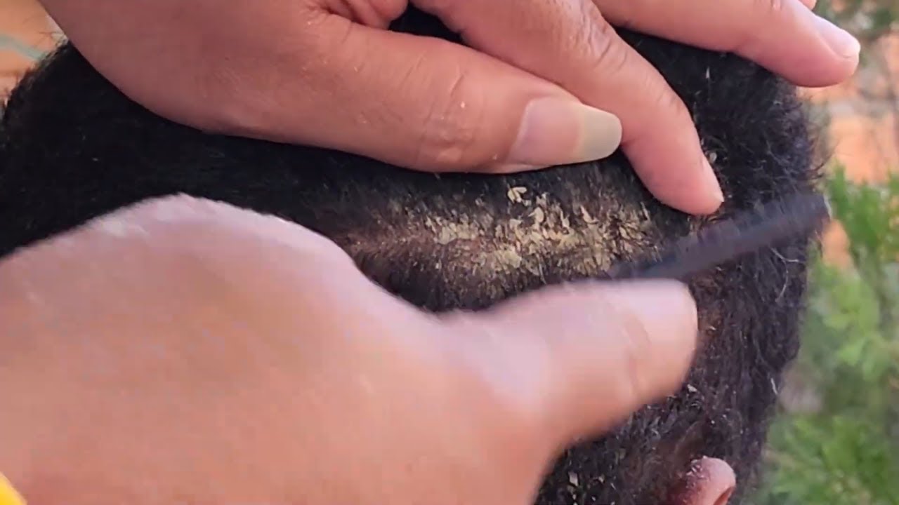 ASMR Scalp Scratching for Sleep and Relaxing Care #473 - YouTube