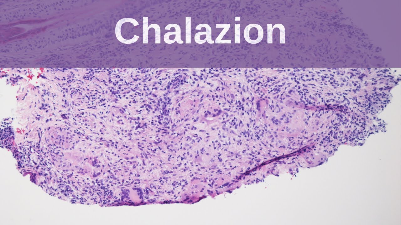 Chalazion Histology