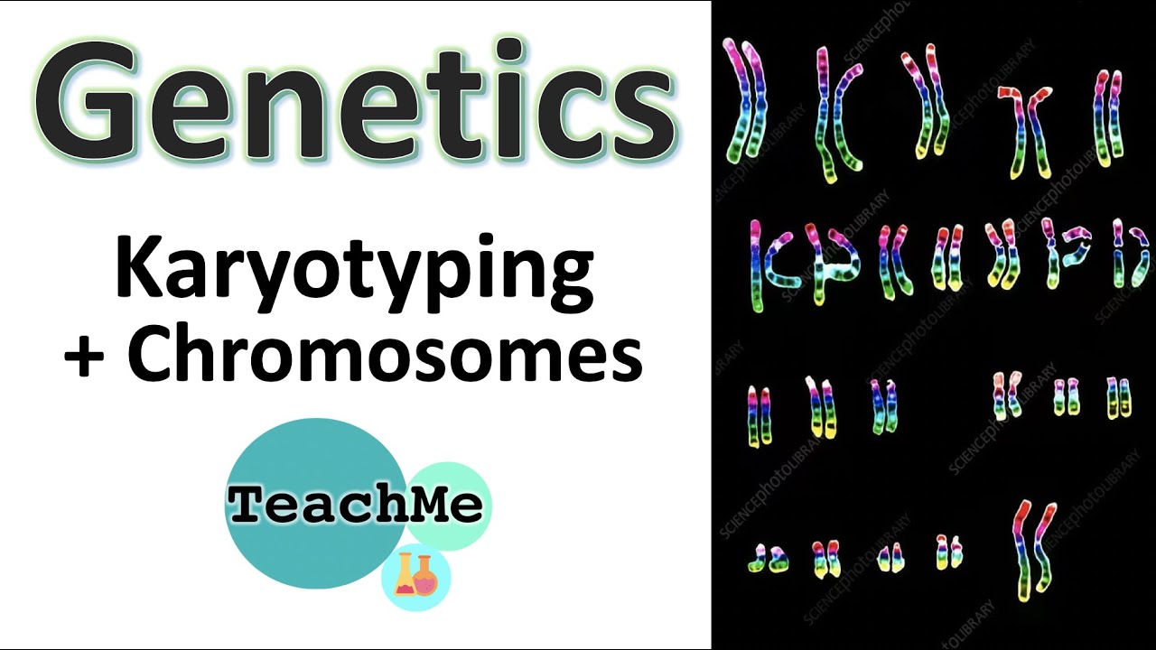 Sickle Cell Anemia Karyotype