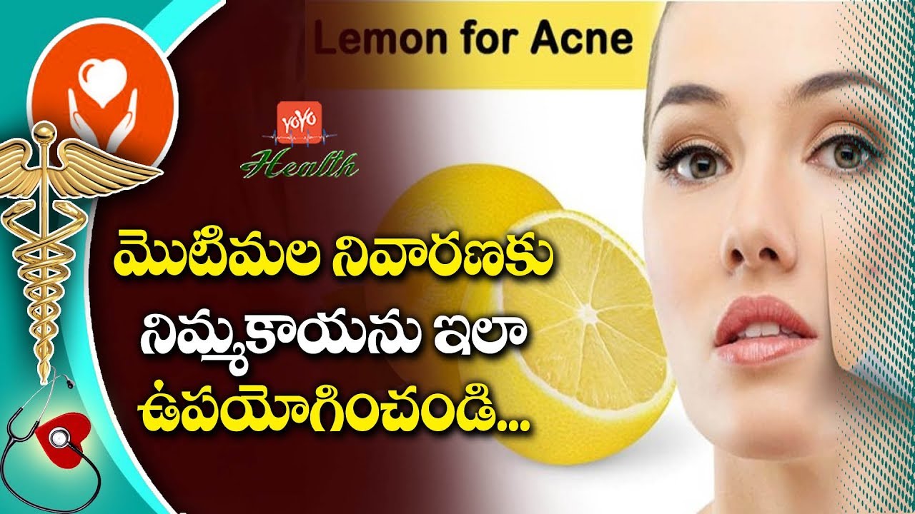 Lemon For Pimples Treatment |Tips To Remove Pimples | Lemon For Acne ...