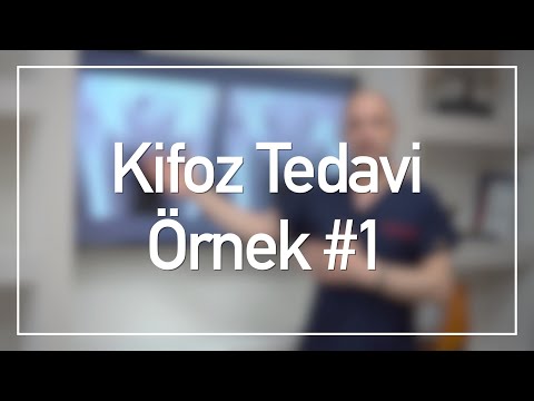 36 Yaş Kamburluk Tedavisi | Kifoz - Kamburluk Tedavi Örnekleri #1