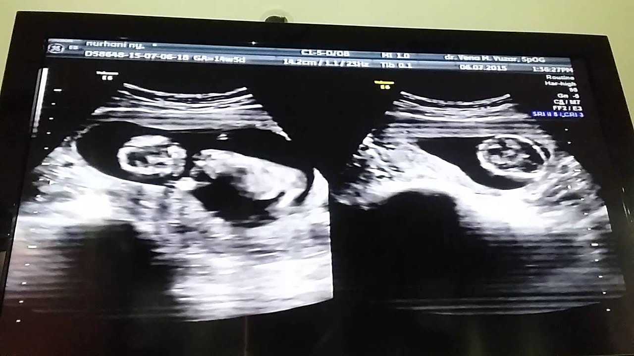 Hamil 15 minggu - YouTube