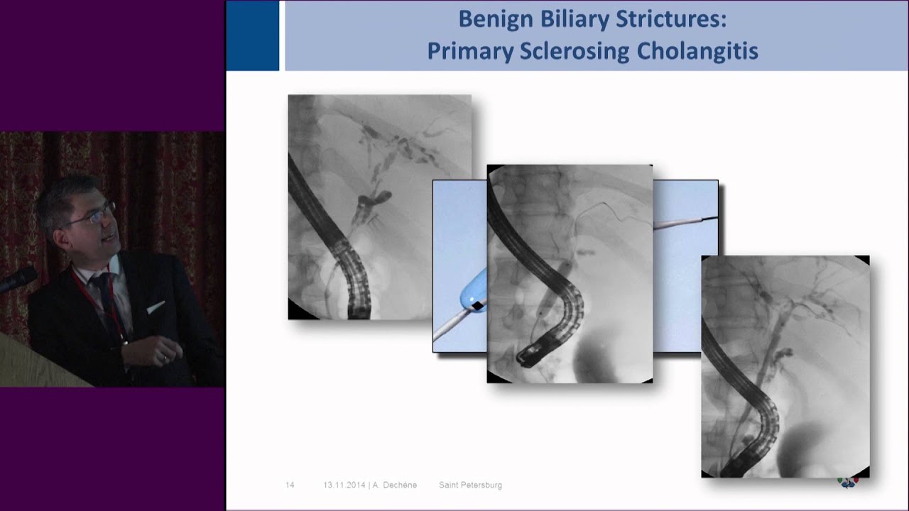 ERCP – Indications and Benefits. "School HPB surgery" - YouTube