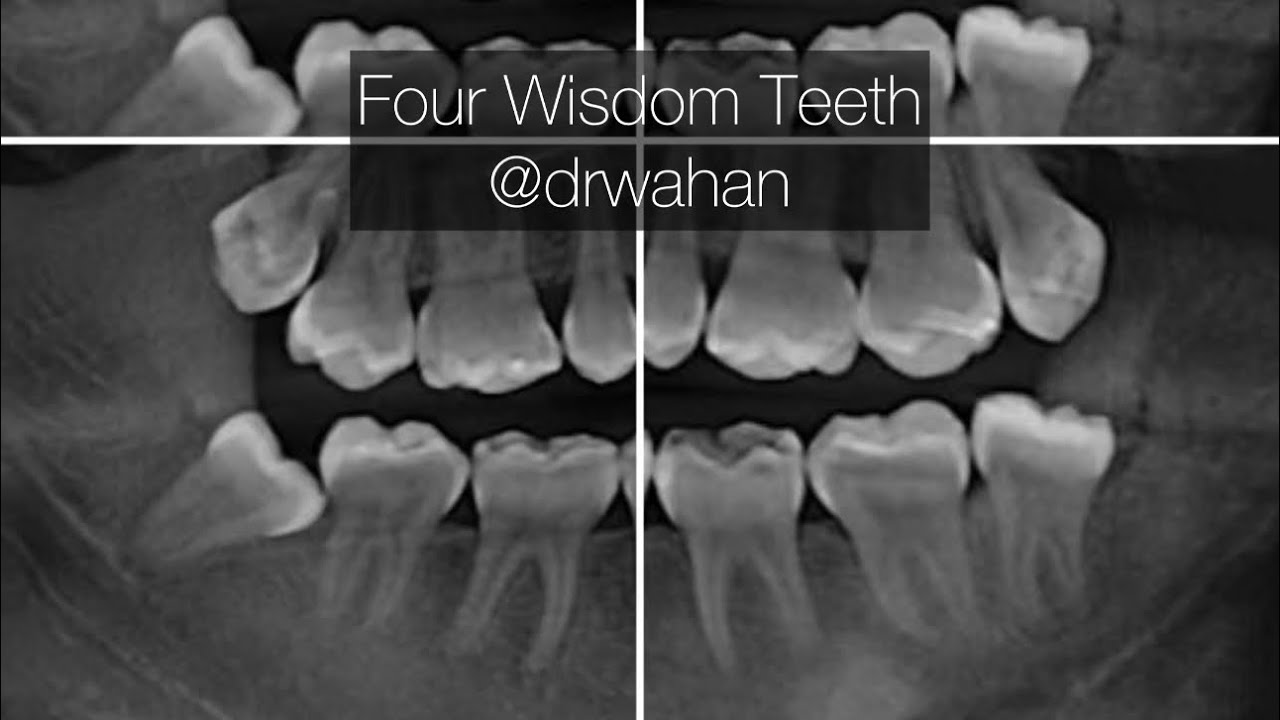 Wisdom Teeth Removal Step by Step @drwahan - YouTube