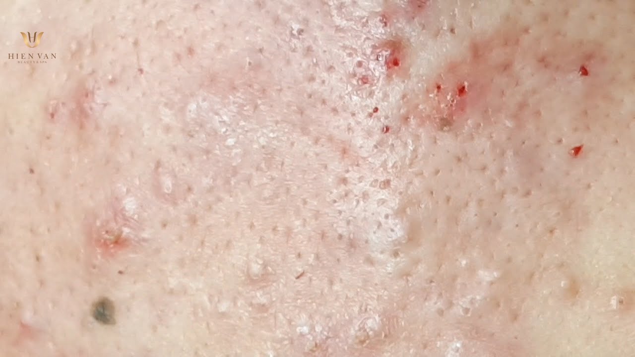 How to pop acne,blackheads,cyst under skin at hien van spa|434|Ngọc ...