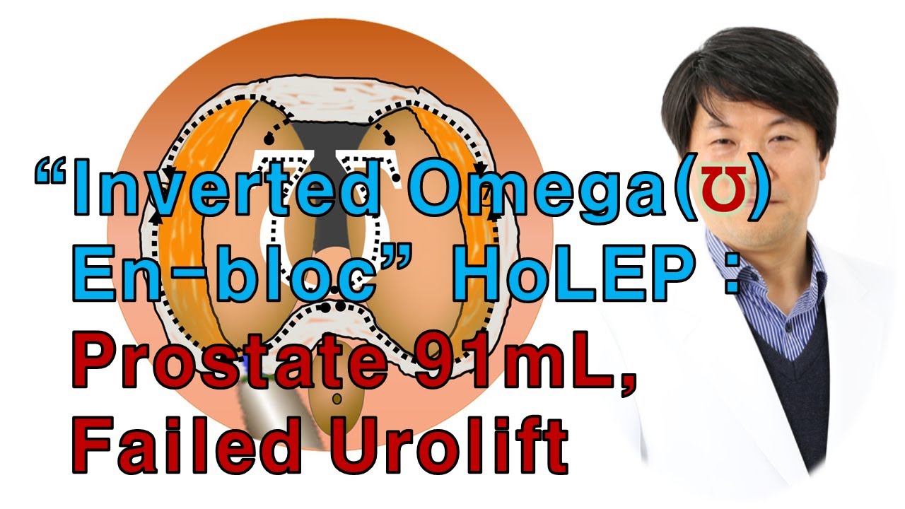 Inverted Omega En-bloc HoLEP technique: Failed Urolift Prostate 91ml ...