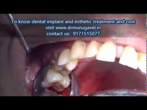 Mobile upper molars extraction and immediate dental implant placement ...