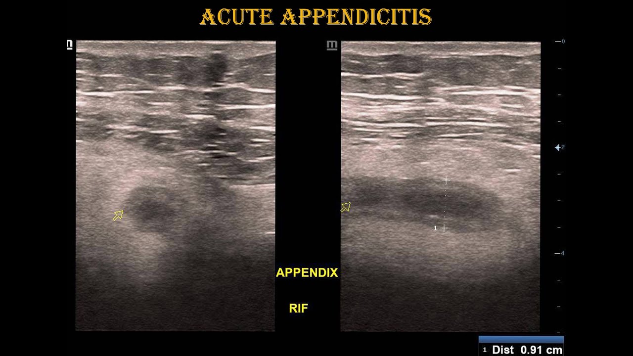 ACUTE APPENDICITIS ON ULTRASONOGRAPHY - YouTube