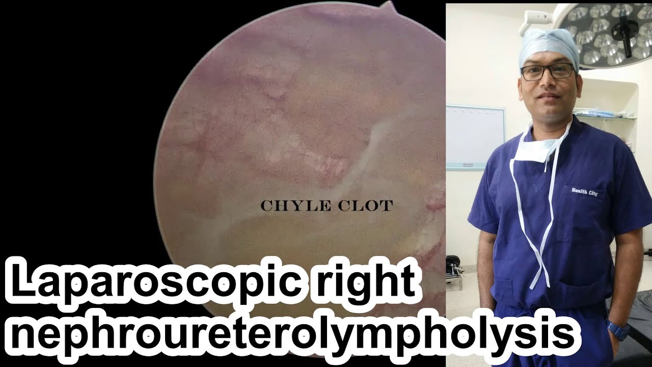 Milky urine|Chyluria|Laparoscopic right lympholysis|Dr Brojen Barman ...