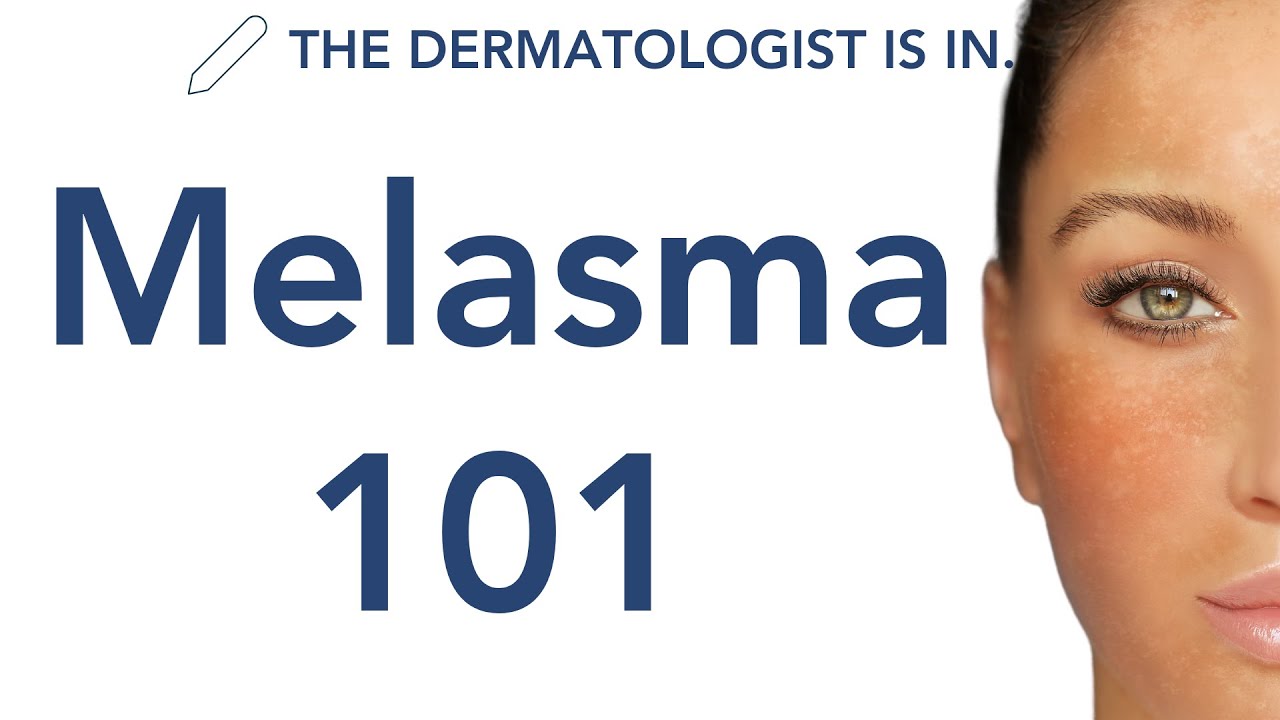 Melasma - Your Complete Guide! - YouTube