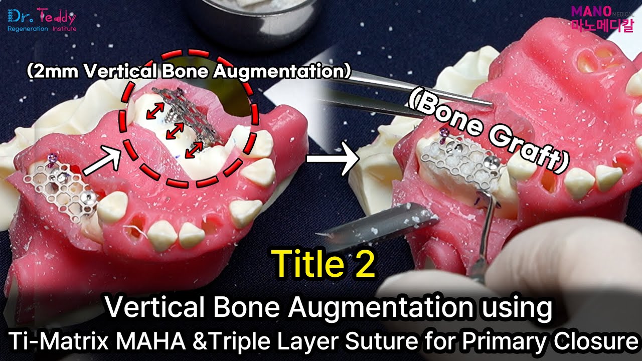 Title 2 : Vertical Bone Augmentation using Ti-Matrix MAHA &Triple Layer ...