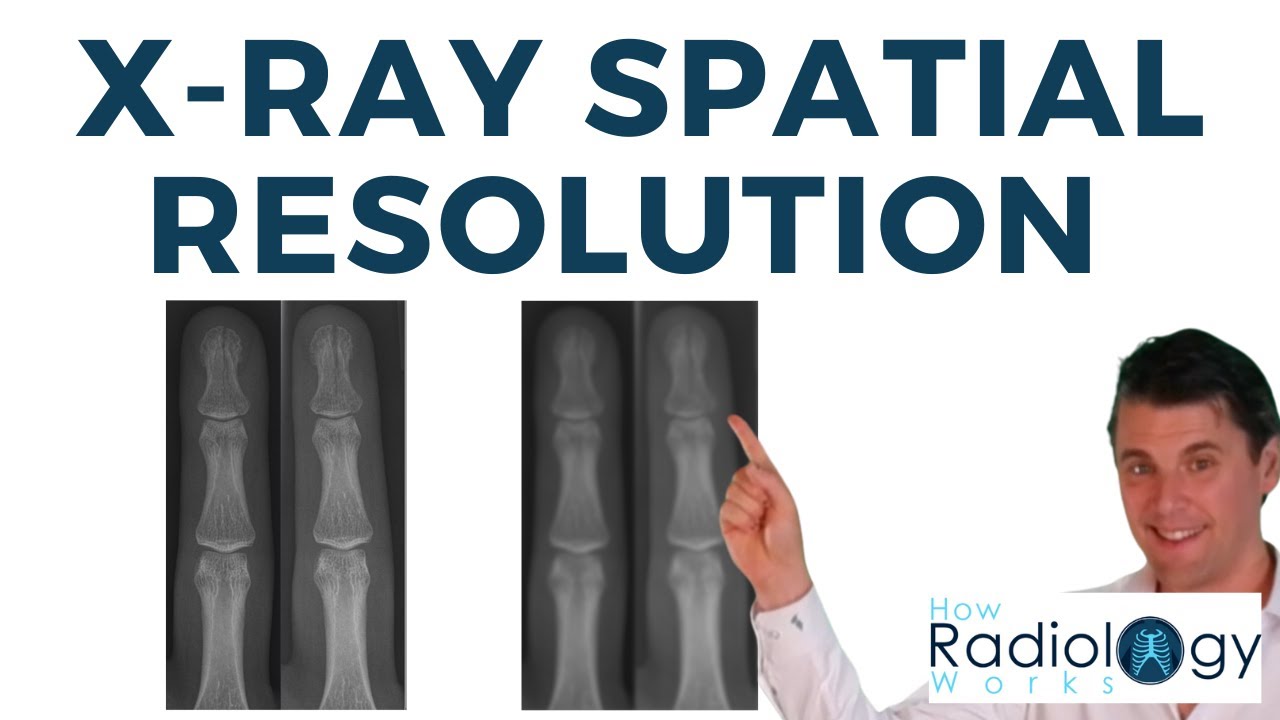 X-ray Spatial Resolution (focal spot, motion, detector) - YouTube