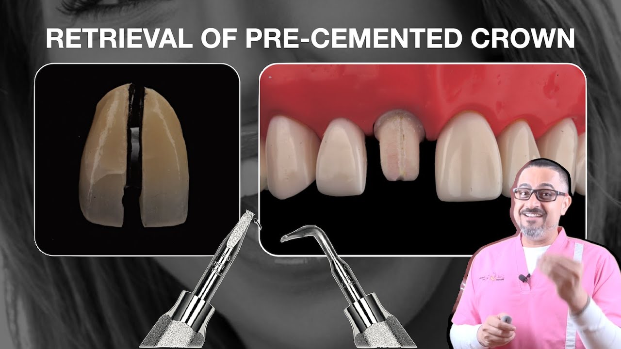 Retrieval of Pre-Cemented Anterior Crown - YouTube
