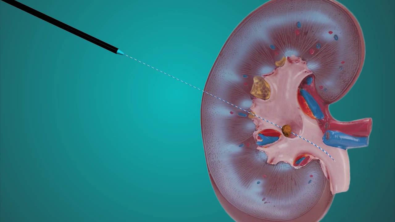 Mechanism of ClearPetra Suction - Evacuation Sheath - YouTube