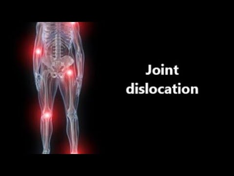 typical deformities after joint dislocation Attitude of limb after ...