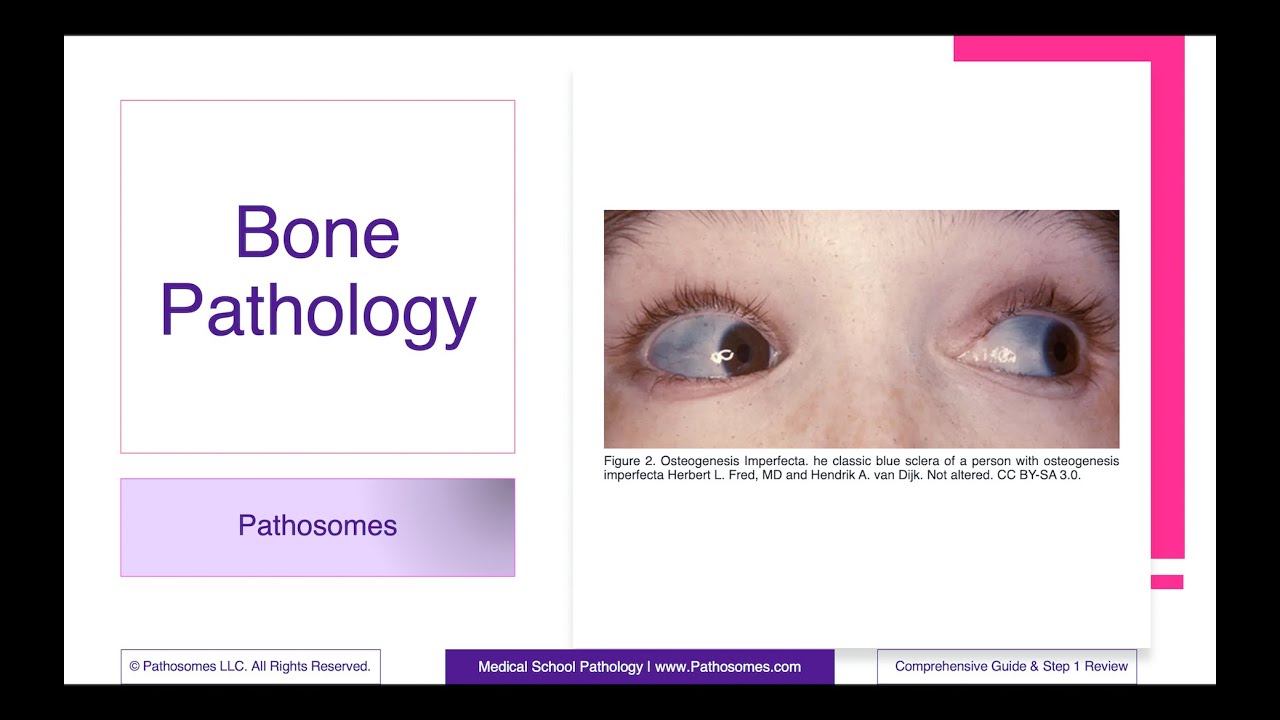 Bone Pathology | Comprehensive Guide & Step 1 Review | Pathology Step 1 ...