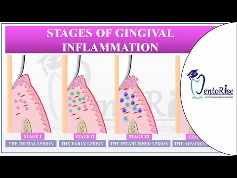 Gingivitis | STAGES OF GINGIVAL INFLAMMATION | Gum disease| Carranza # ...