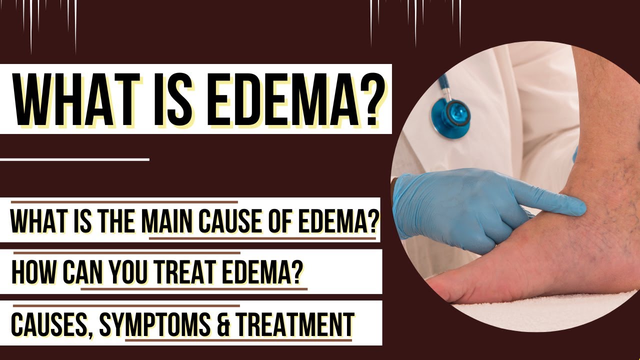 What Is Edema? What is the main cause of edema? Causes, Symptoms ...