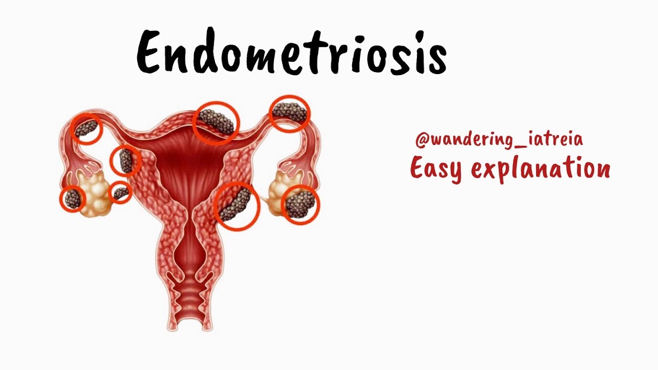 Endometriosis Easy Explanation Subscribe Shortvideo Endometriosis