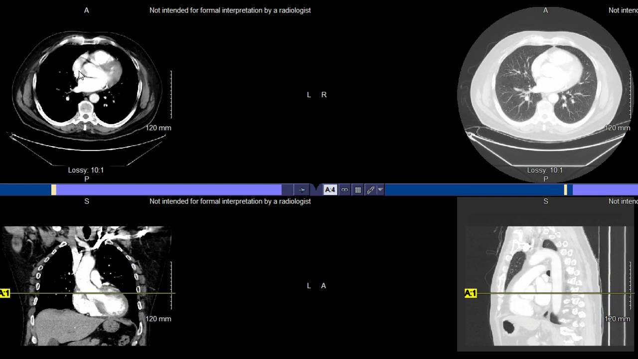 PACS - CT Thorax - YouTube