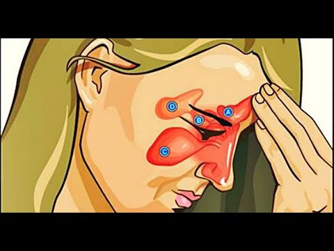 SINUSITE - Tratamento natural com alimentação e suplementos (DICAS + Receitinha ao final)