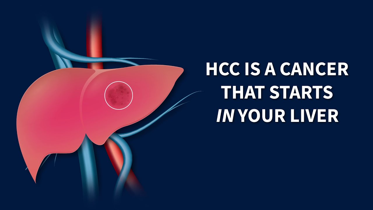 Primary Liver Cancer - Understanding HCC - YouTube