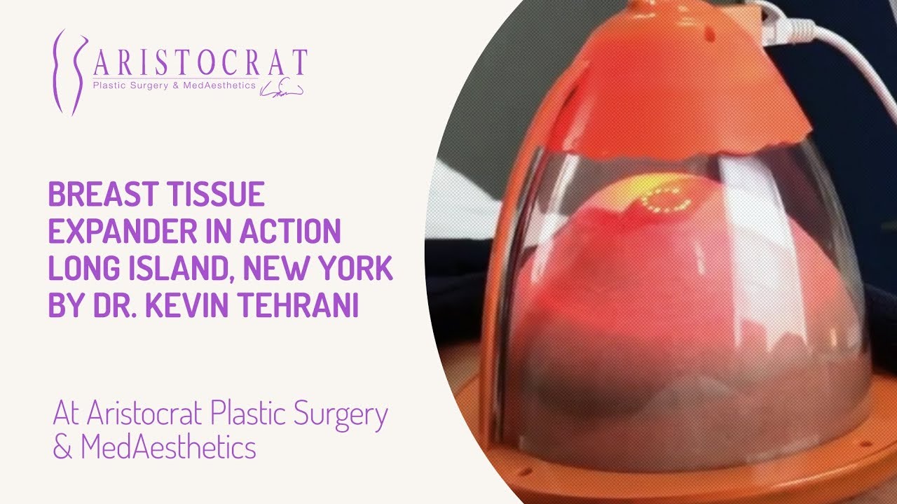 Breast Tissue Expander In Action Long Island New York By Dr Kevin Tehrani Youtube