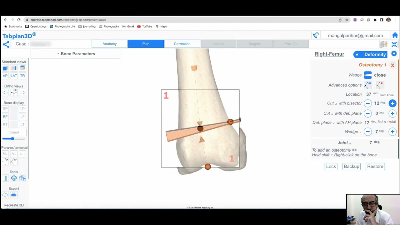 Distal Femur Osteotomy (DFO) - Fixation by Plate and Auto-design of ...