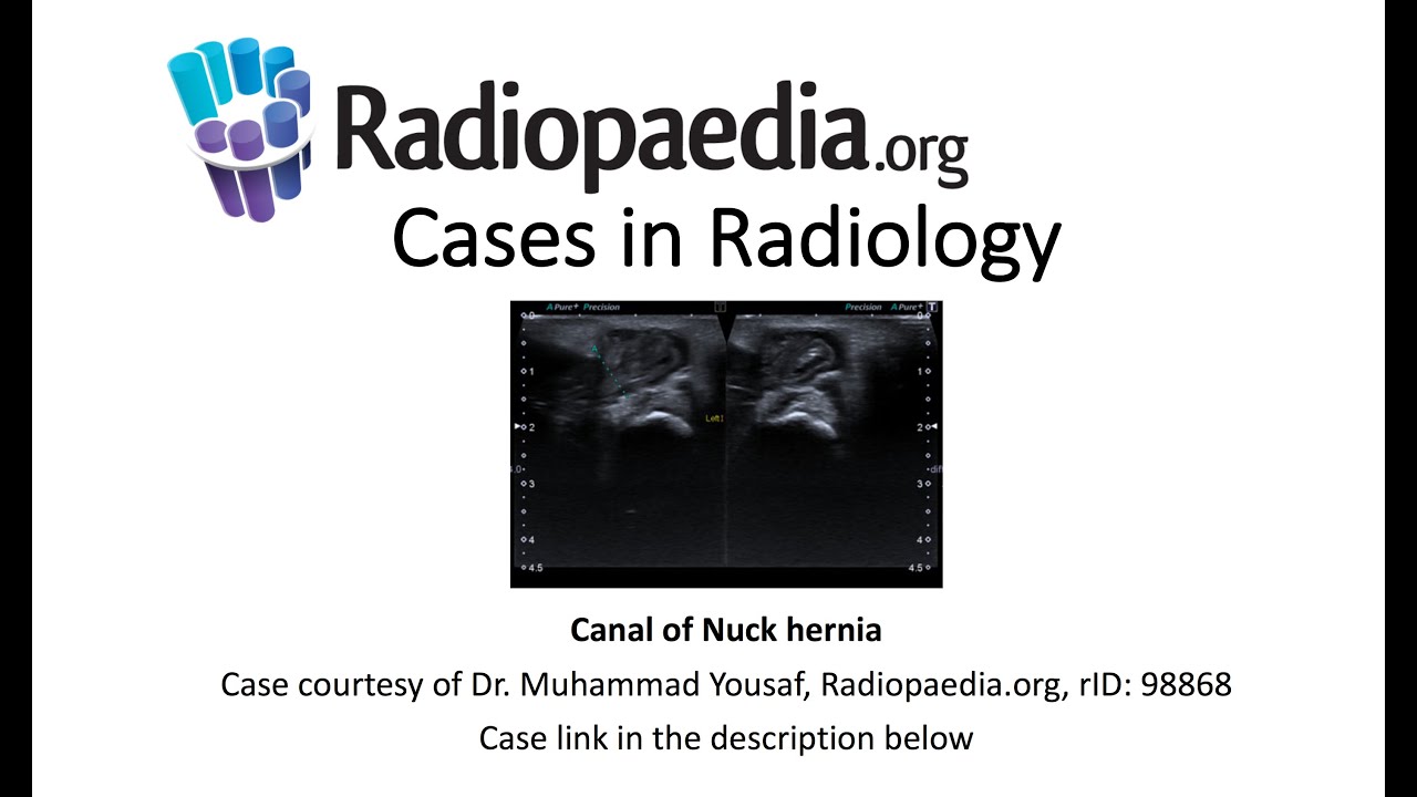 Canal of Nuck hernia (Radiopaedia.org) Cases in Radiology - YouTube