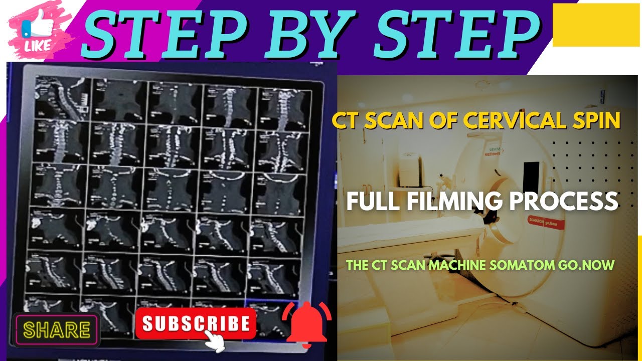 Cervical Spine CT Scan trauma Patients fracture of C6 C7 #ctscan # ...