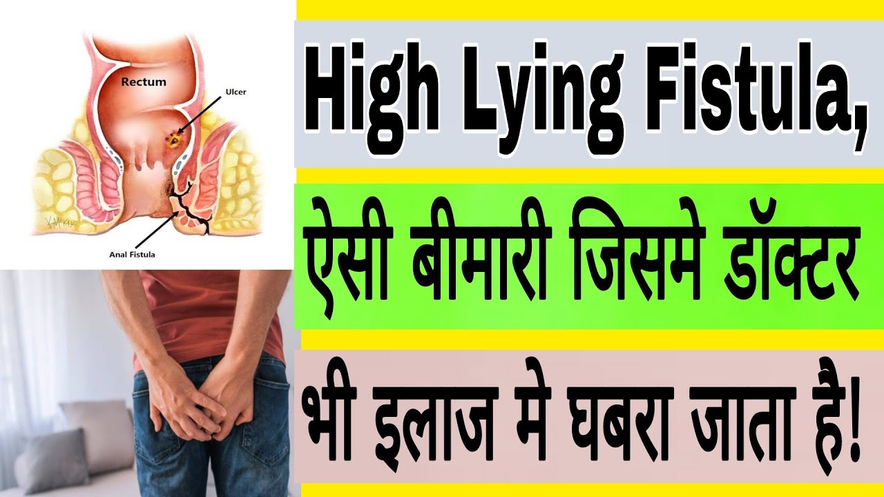 High Lying Fistula,ऐसा फिस्टुला जिसका उपचार करने मे डॉक्टर भी परेशान हो ...