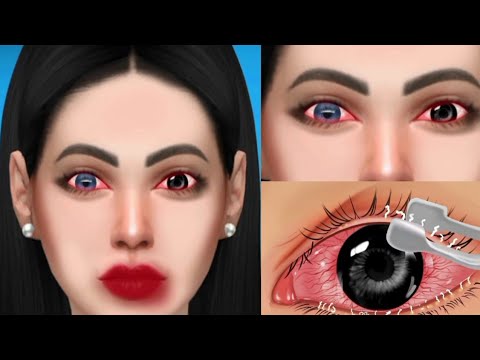 ASMR Eye discharge removal animation - Eyelid big acne extrusion and ...