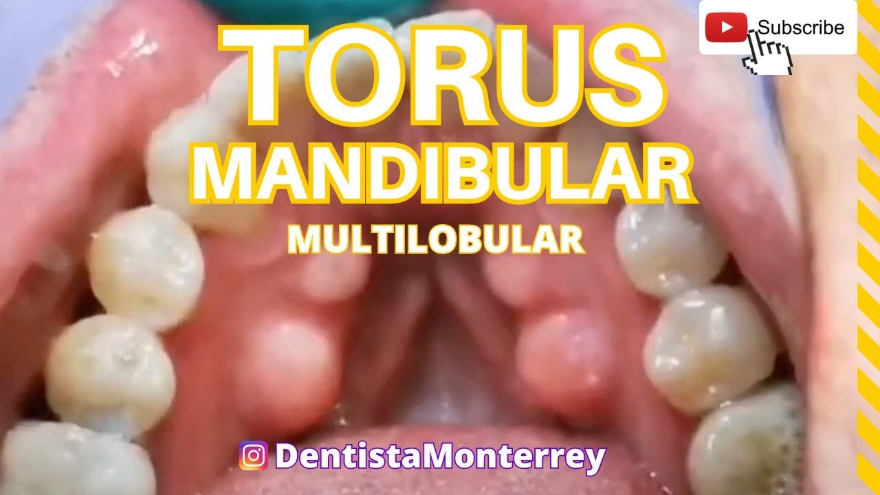 TORUS 👅 PORQUE SALEN y TRATAMIENTO - YouTube