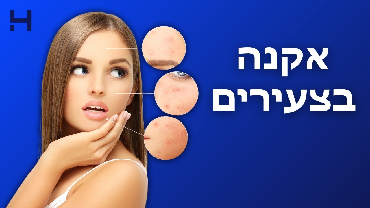 אקנה בצעירים אני רק שאלה הדסה טי וי Youtube