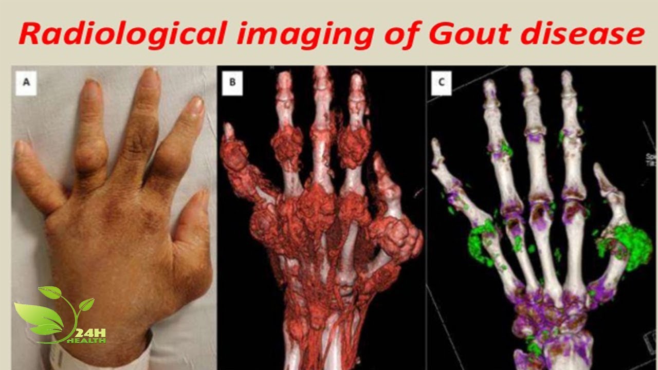 [ GOUT TREATMENT ] How To Cure Gout Naturally At Home & AMAZING Foods ...
