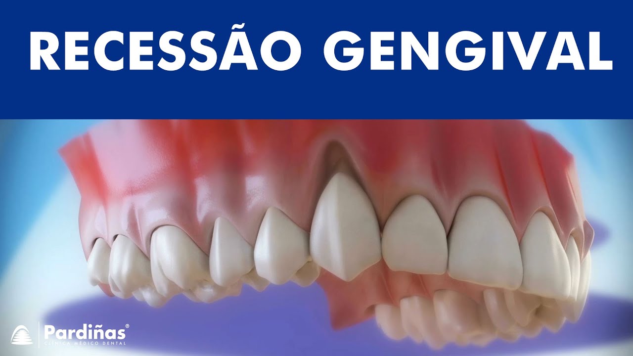 Recessão gengival - Tratamento da retração da gengiva © - YouTube