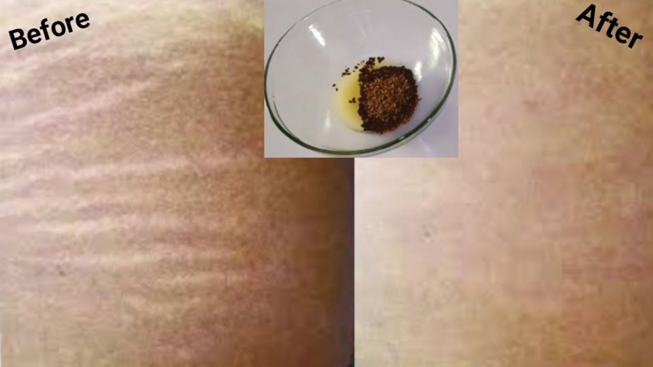 Clear all Stretch Marks no matter how old | How to get rid of Stretch ...