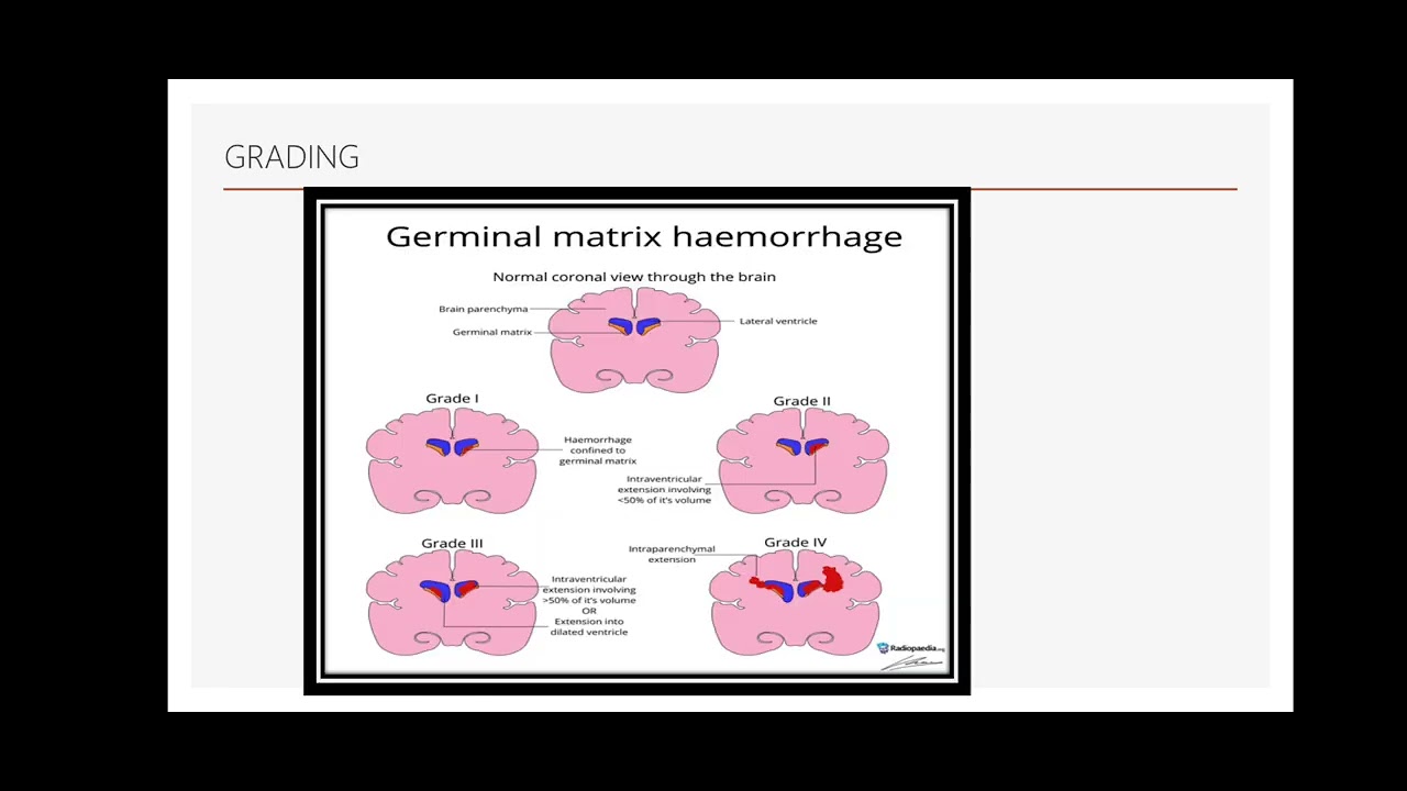 Intraventricular Haemorrhage Ivh Germinal Matrix Hemorrhage