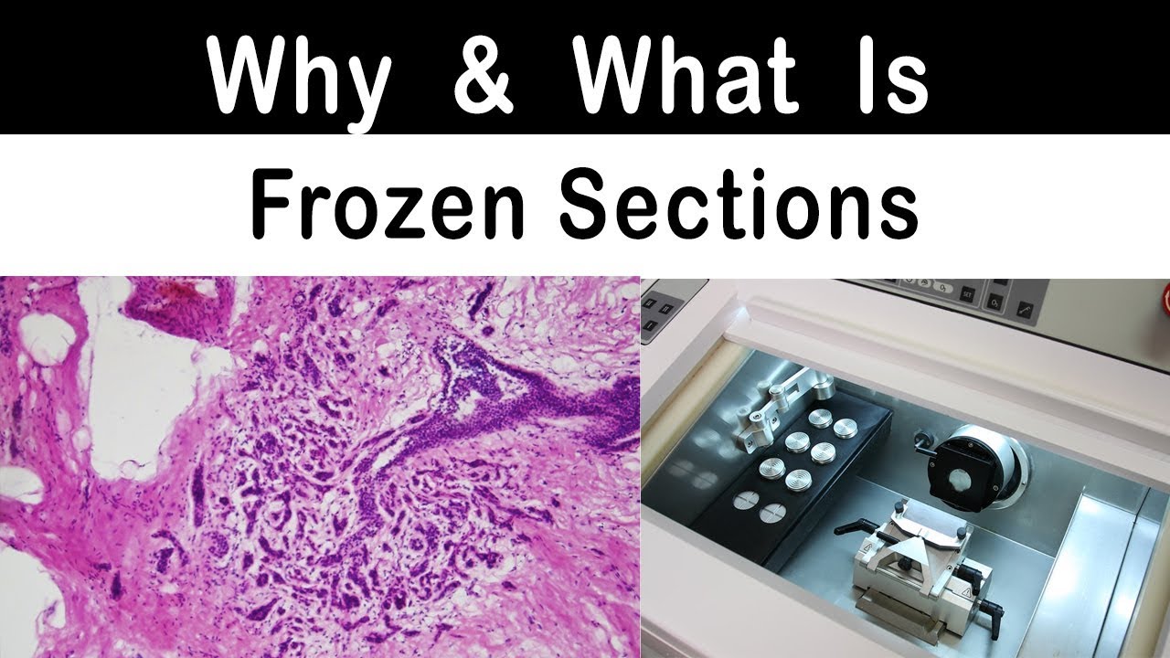 Why and what is Frozen Sections ? - YouTube
