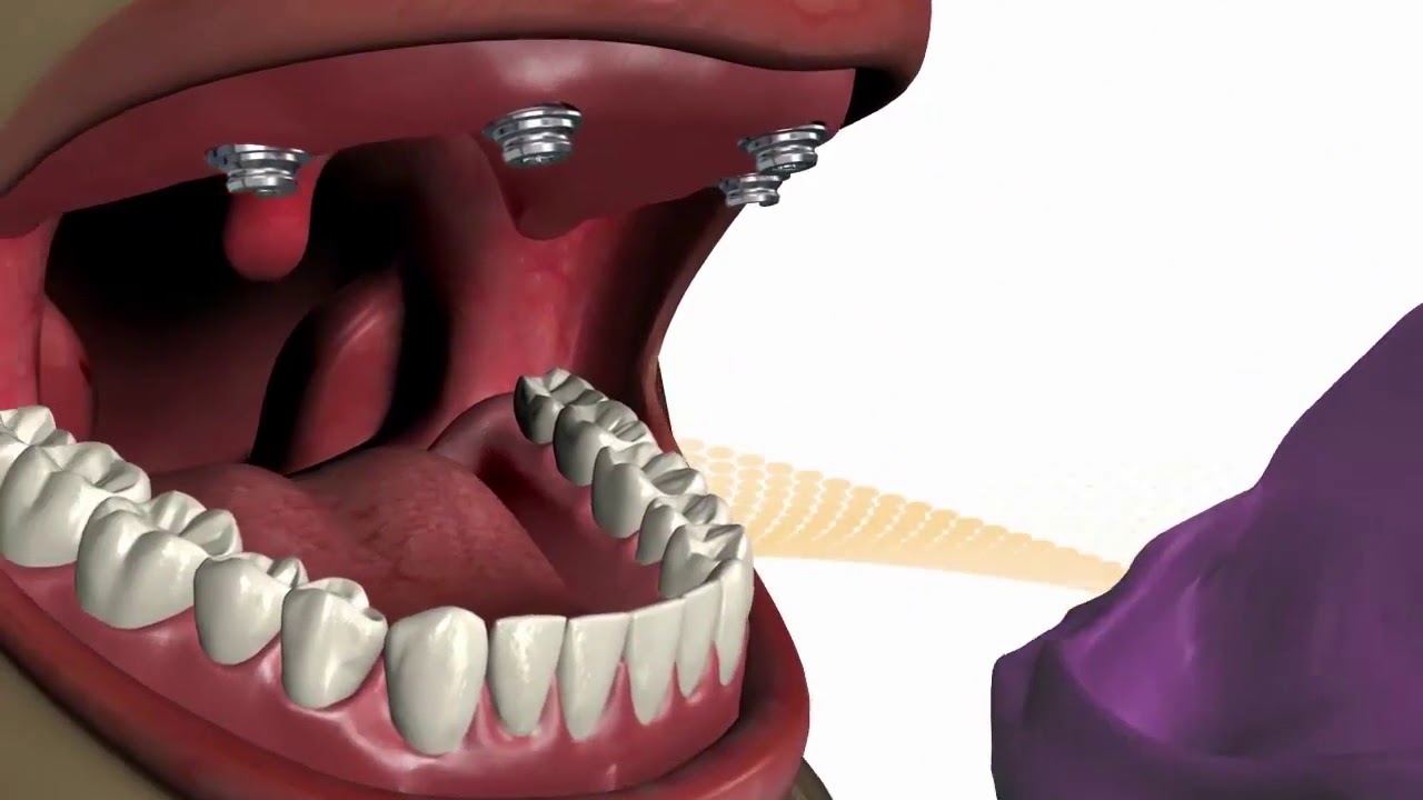 InterActive All-in-1 Arch Procedure from Implant Direct - YouTube