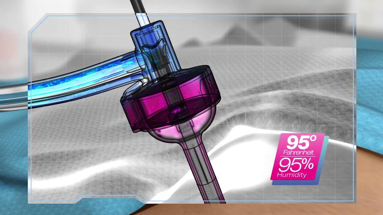 LEXION Medical Insuflow® Synergy® Port Series - YouTube