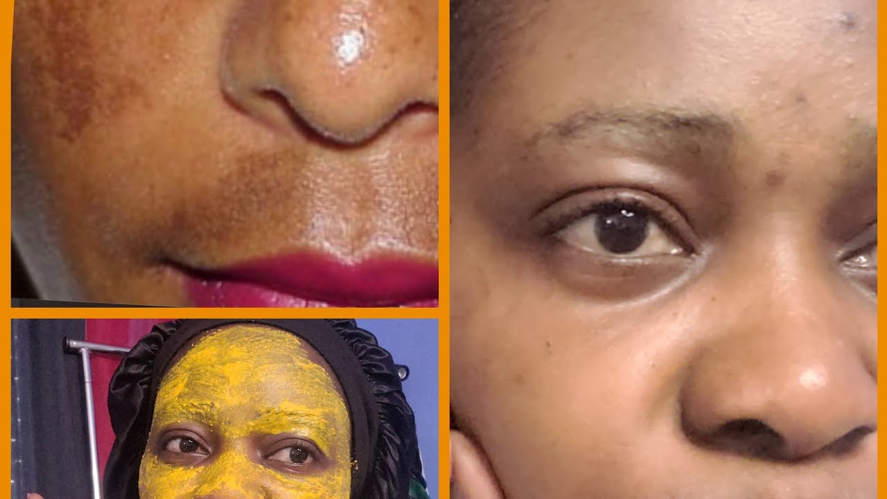 Comment traiter les taches d'hyperpigmentation du visage #tampon # ...