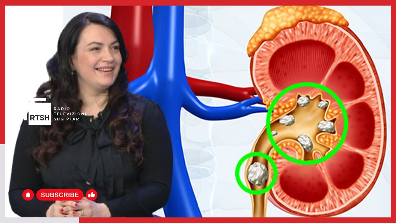 "Kemi hasur në gurë koraliformë te veshka", mjekja: I kanë zbuluar pas ...