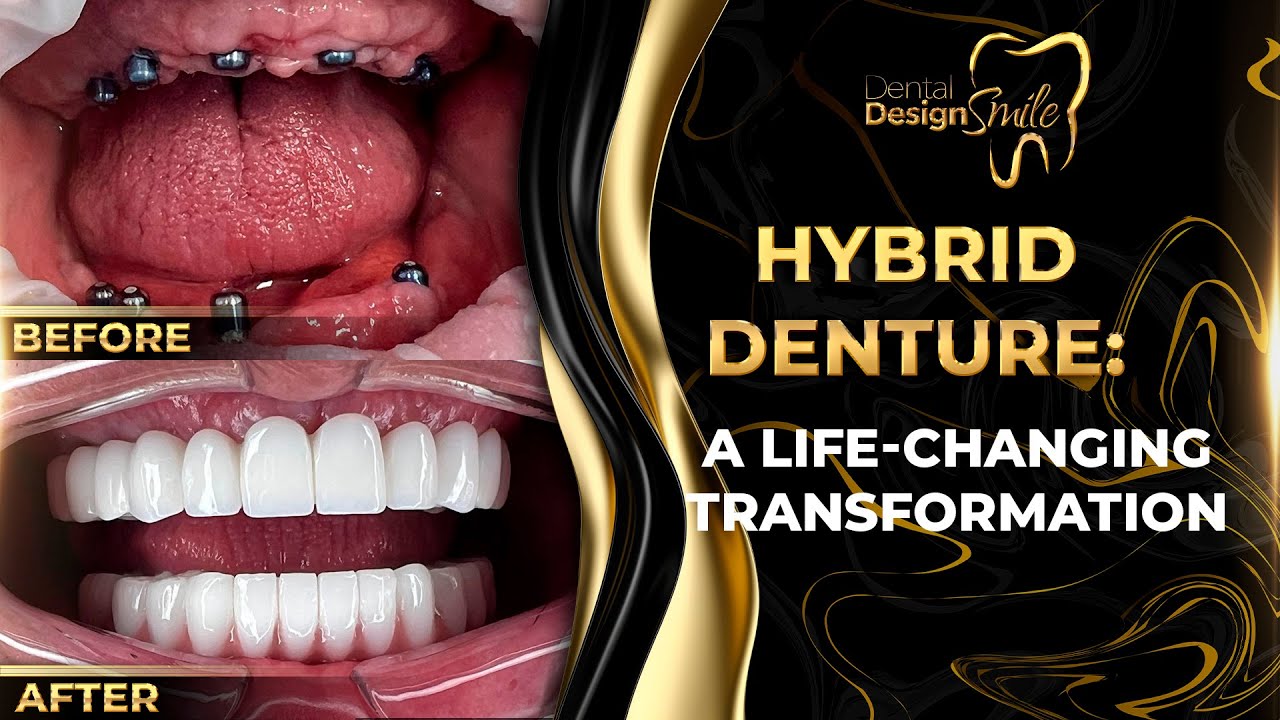 Hybrid Denture: A Life-Changing Transformation - YouTube